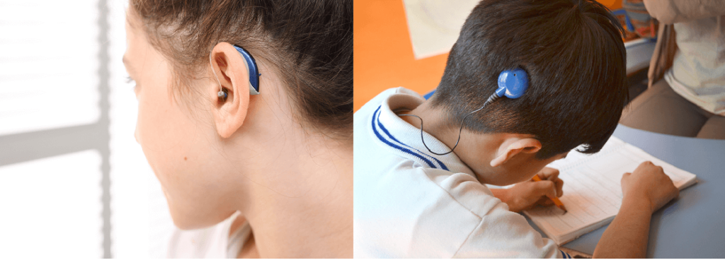 Hearing Aid Devices vs. Cochlear Implants: Top 10 Differences | Sphere ...