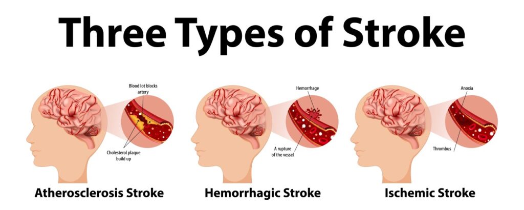 Stroke: 10 Shocking Causes of Speech Slurred Stroke You Need to Know | Sphere Speech & Hearing Care