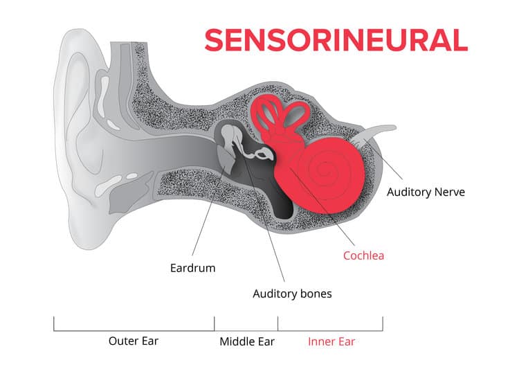Sensorineural Hearing Loss Diagnosis: 10 Essential Tests You Must Know ...